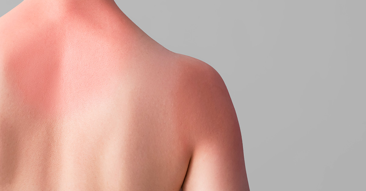 Remedios para quemaduras de sol con ingredientes que tienes en casa ...